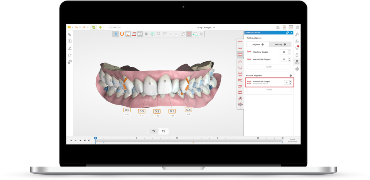 Spark™-releases - Het laatste nieuws over Spark-aligners